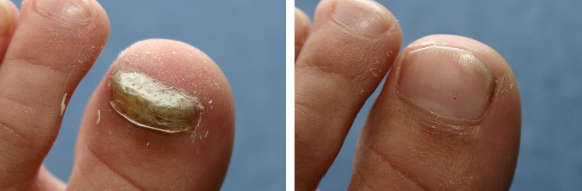 Mykosen der Haut | SpringerLink