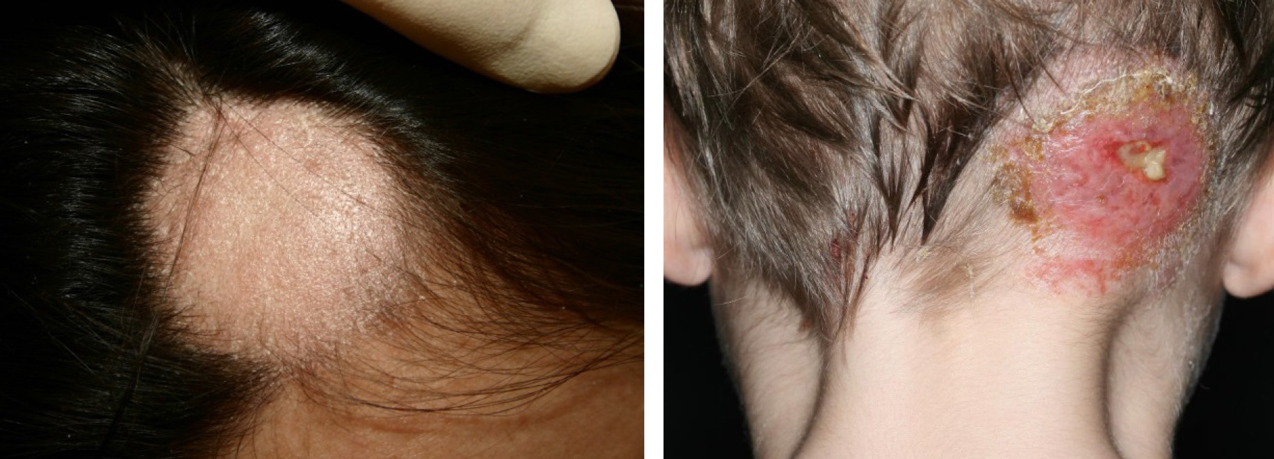 Mykosen der Haut | SpringerLink