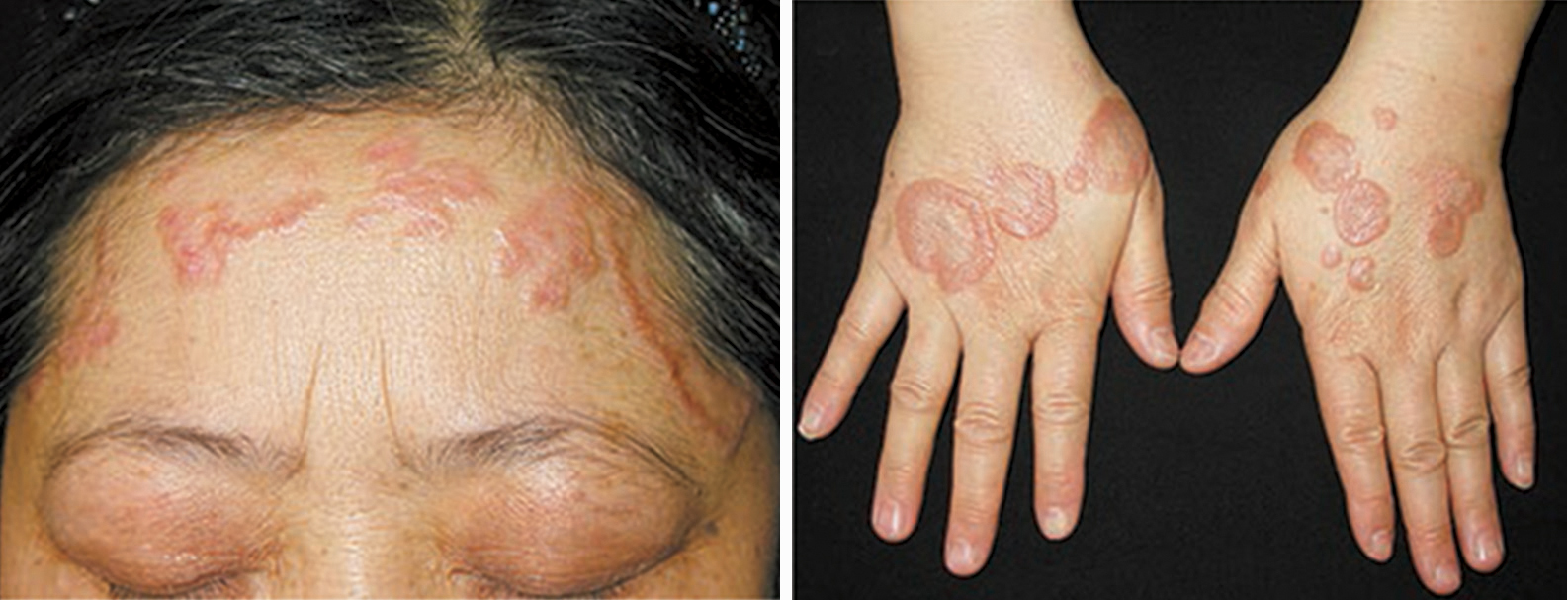 Ringförmige Läsionen auf Stirn und Händen | SpringerLink