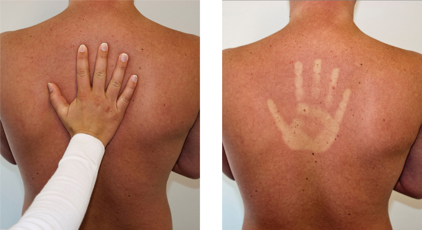 Differenzialdiagnose Exanthem und Fieber nach Tropenaufenthalt ...