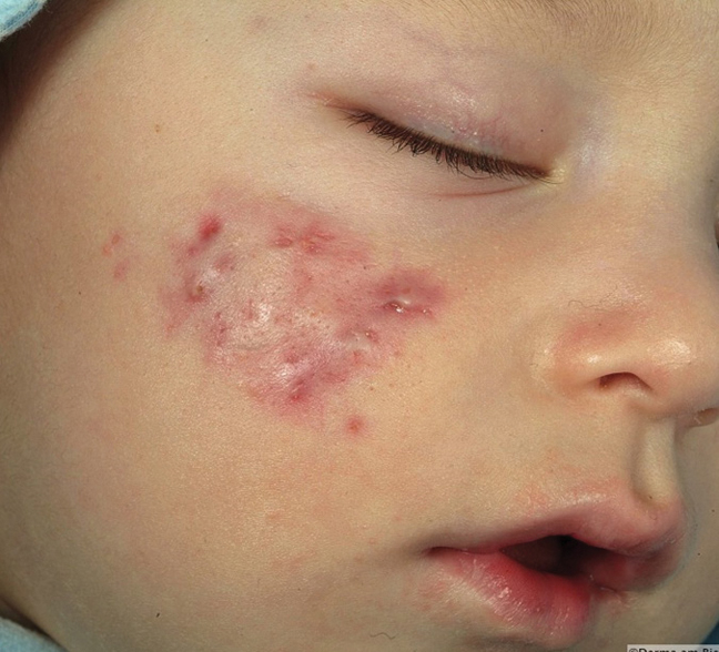 Akne: Nicht nur in der Pubertät | SpringerLink