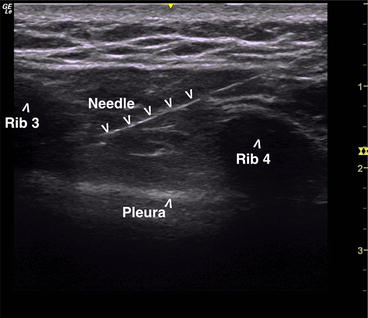 Ultrasound-Guided Parasternal Block Allows Optimal Pain Relief and ...