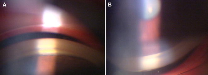 Multiple Layers Lens Capsule True Exfoliation in Patient with Primary ...