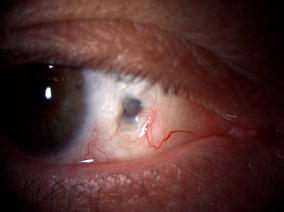 Use of an Autologous Lamellar Scleral Graft to Repair a Scleral Melt ...