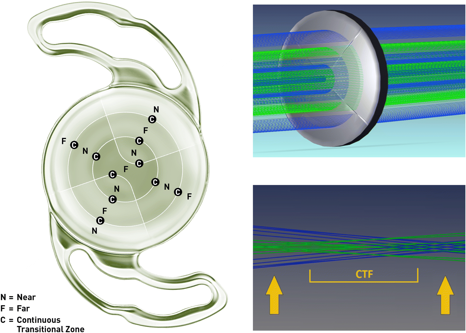 Continuous Transitional Focus (CTF): A New Concept in Ophthalmic ...