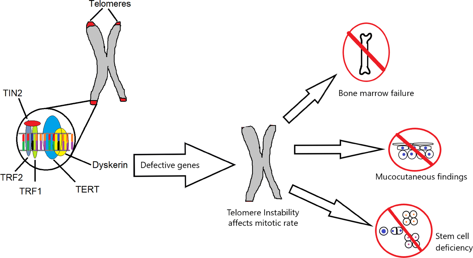 Dyskeratosis Congenita and Corneal Refractive Surgery | SpringerLink