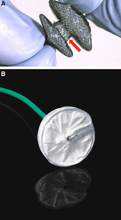 Atrial Septal Defect Device Closure in the Pediatric Population: A ...