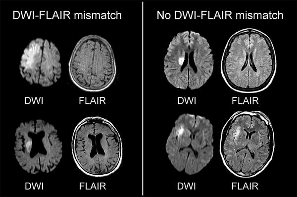 Treating Wake-Up Stroke Patients | SpringerLink