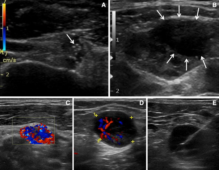 Groin Lymph Nodes Ultrasound