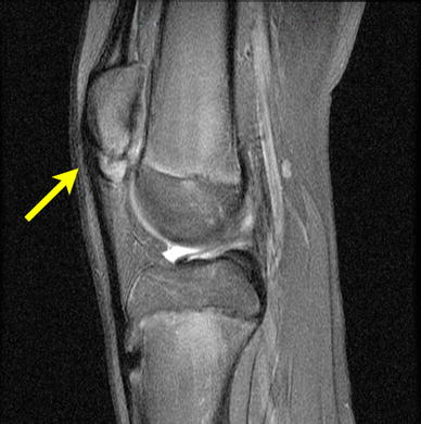 MRI of Sports Injuries in Children and Adolescents: What’s Different ...