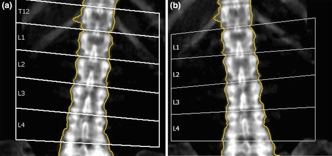 A Practical Approach to Interpretation of Dual-Energy X-ray ...