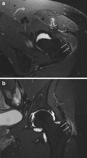 MRI of the Hip: Important Injuries of the Adult Athlete | SpringerLink