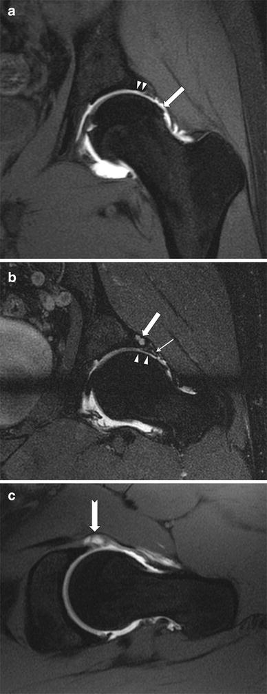 MRI of the Hip: Important Injuries of the Adult Athlete | SpringerLink
