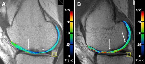 T2 and T2* Mapping | SpringerLink