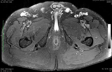 Role of MRI in Ano-rectal Fistulas | SpringerLink