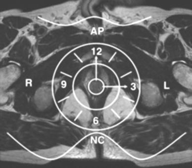 Role of MRI in Ano-rectal Fistulas | SpringerLink