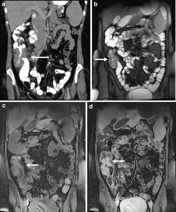 Role of CT and MRI in Abdominal Tuberculosis | SpringerLink