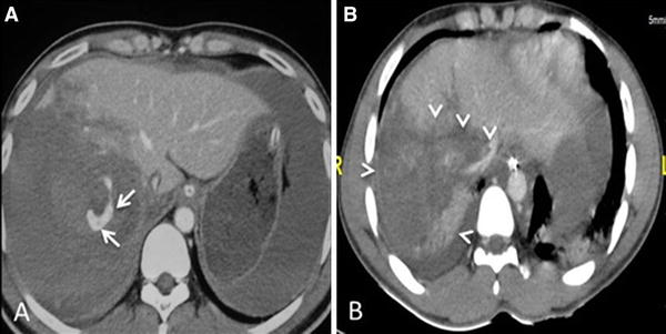 Role of CT in Abdominal and Pelvic Trauma | SpringerLink