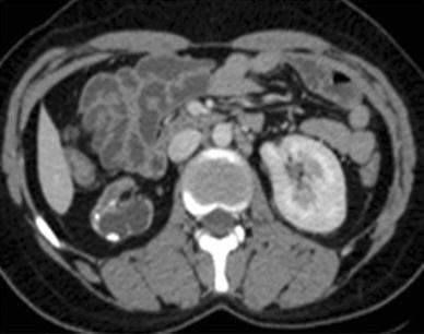 Multidetector CT in Renal Tuberculosis | SpringerLink