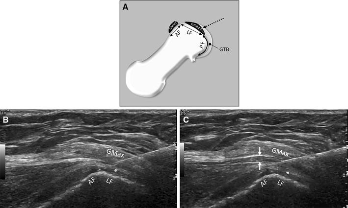 Interventional Musculoskeletal Ultrasound | SpringerLink
