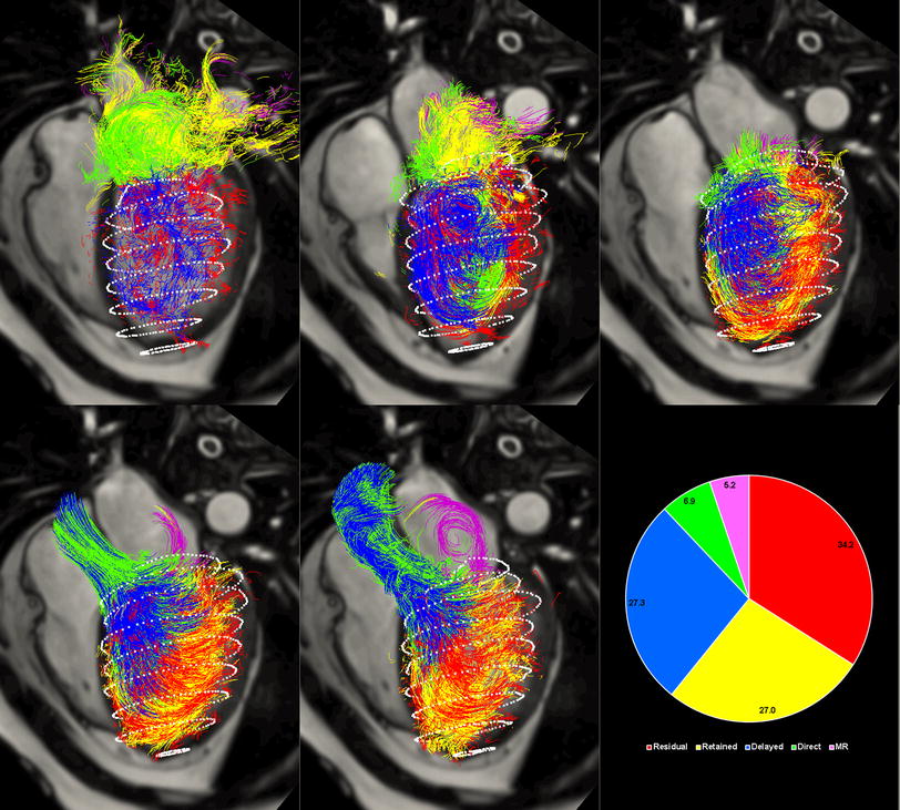 Advanced Analysis Techniques for Intra-cardiac Flow Evaluation from 4D ...