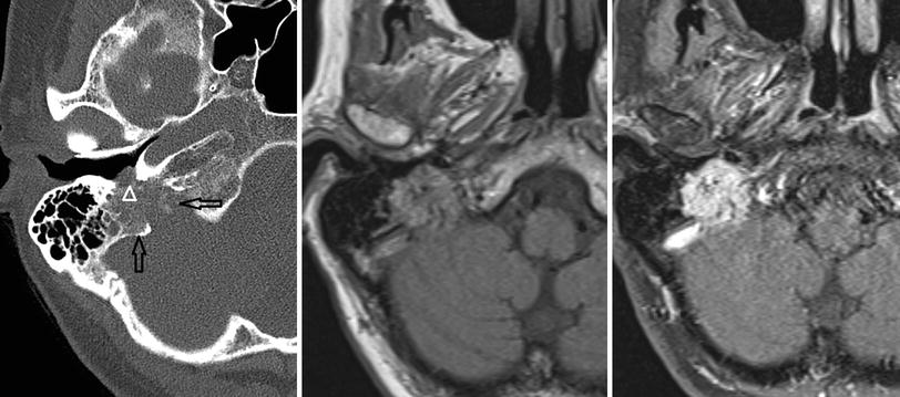 Pulsatile Tinnitus: Differential Diagnosis and Radiological Work-Up ...