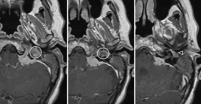 Pulsatile Tinnitus: Differential Diagnosis and Radiological Work-Up ...