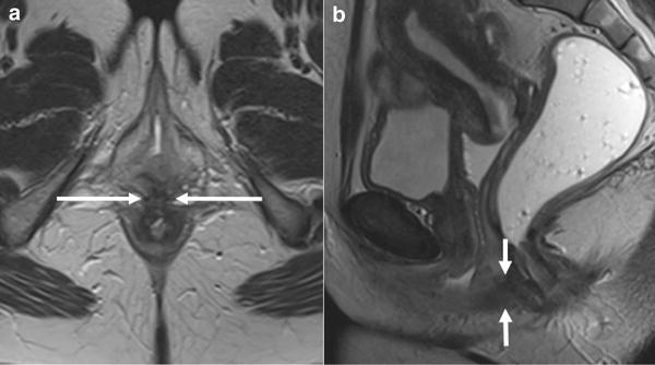 Magnetic Resonance Imaging of Female Pelvic Floor Dysfunction: A Review ...