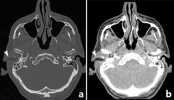 Advanced Imaging Techniques in Skull Base Osteomyelitis Due to ...