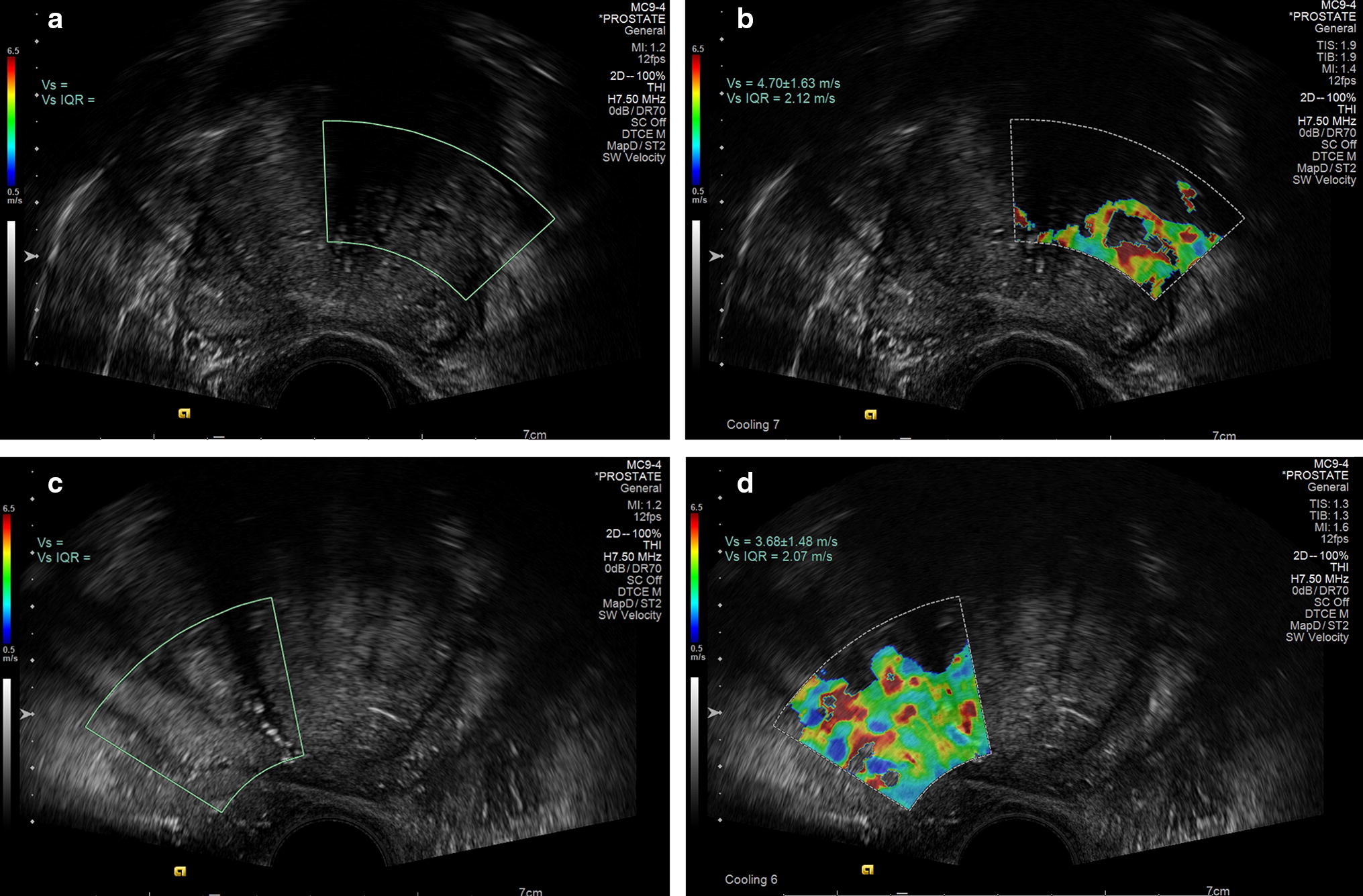 Prostate Cancer Detection and Diagnosis: Role of Ultrasound with MRI ...