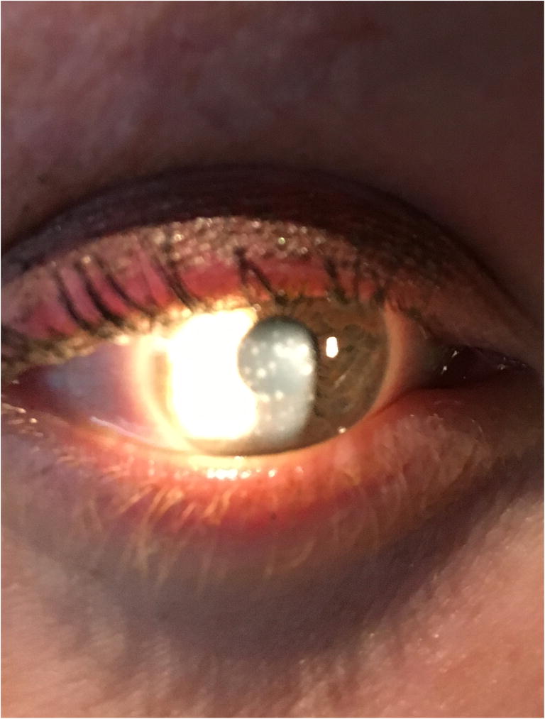 Adenoviral Keratoconjunctivitis: Diagnosis, Management, and Prevention ...