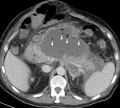 Video-Assisted Retroperitoneal Debridement (VARD) of Infected ...