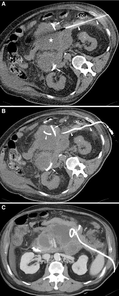 Video-Assisted Retroperitoneal Debridement (VARD) of Infected ...