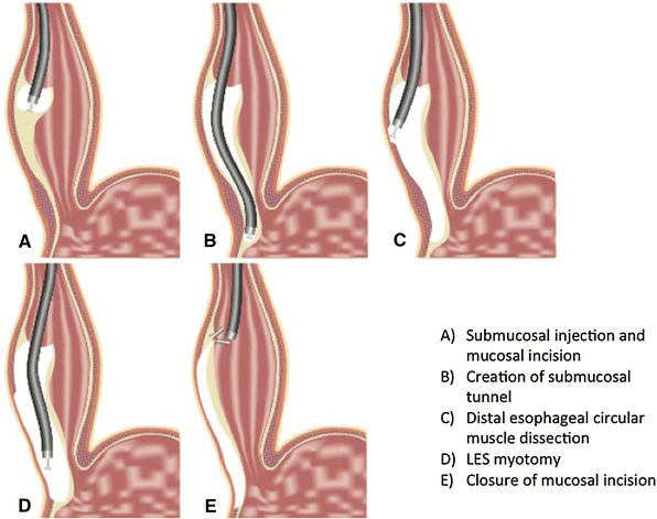 Per Oral Endoscopic Myotomy (POEM): Review of Current Techniques and ...