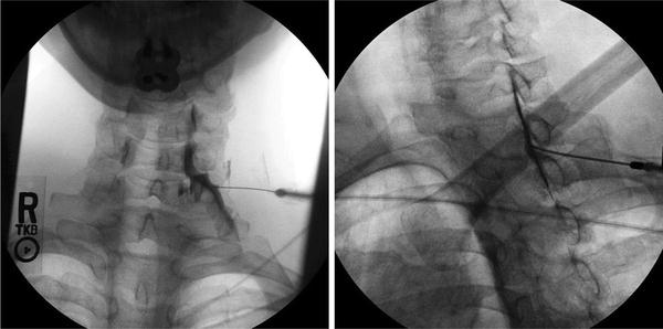 Cervical Foraminal Versus Interlaminar Epidurals: Risks, Benefits, and ...