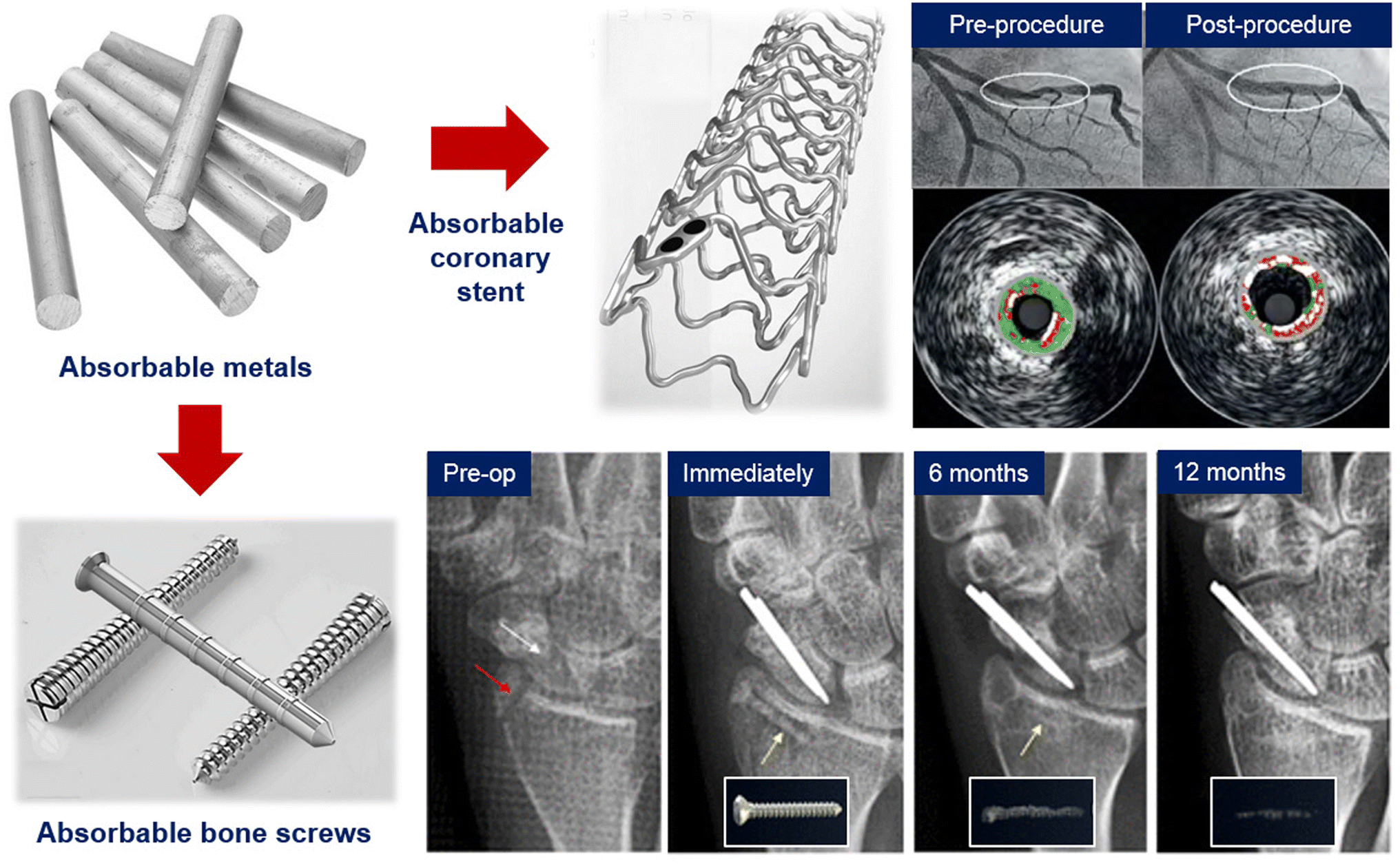 Updates on the research and development of absorbable metals for ...