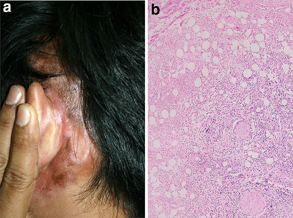 Hair and Scalp Changes in Cutaneous and Systemic Lupus Erythematosus ...