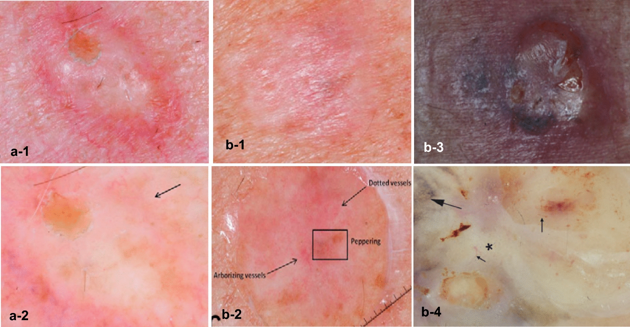 Unusual Clinical Presentations of Malignant Melanoma: A Review of ...