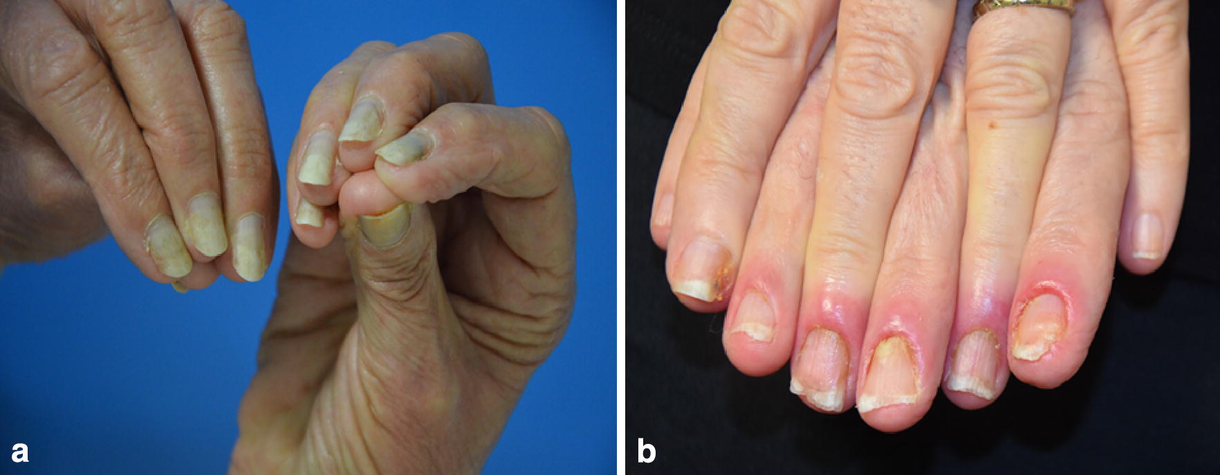 Toxic Side Effects of Targeted Therapies and Immunotherapies Affecting ...