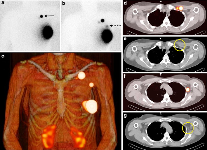 SPECT/CT and sentinel node lymphoscintigraphy | SpringerLink
