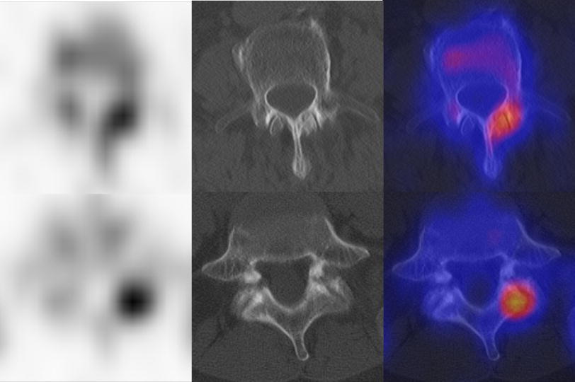 Skeletal SPECT/CT: a review | SpringerLink