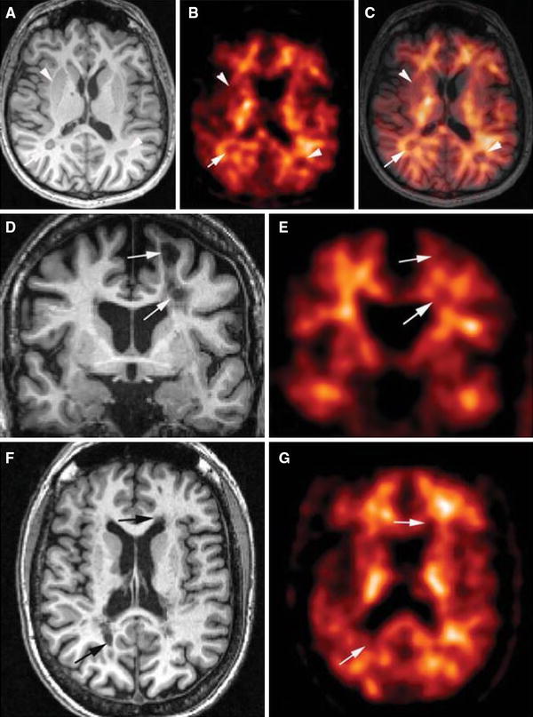 Amyloid PET imaging: applications beyond Alzheimer’s disease | SpringerLink