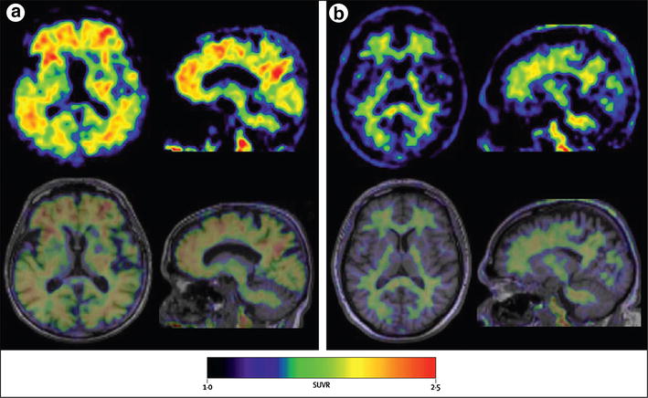 Beta-amyloid imaging with florbetaben | SpringerLink