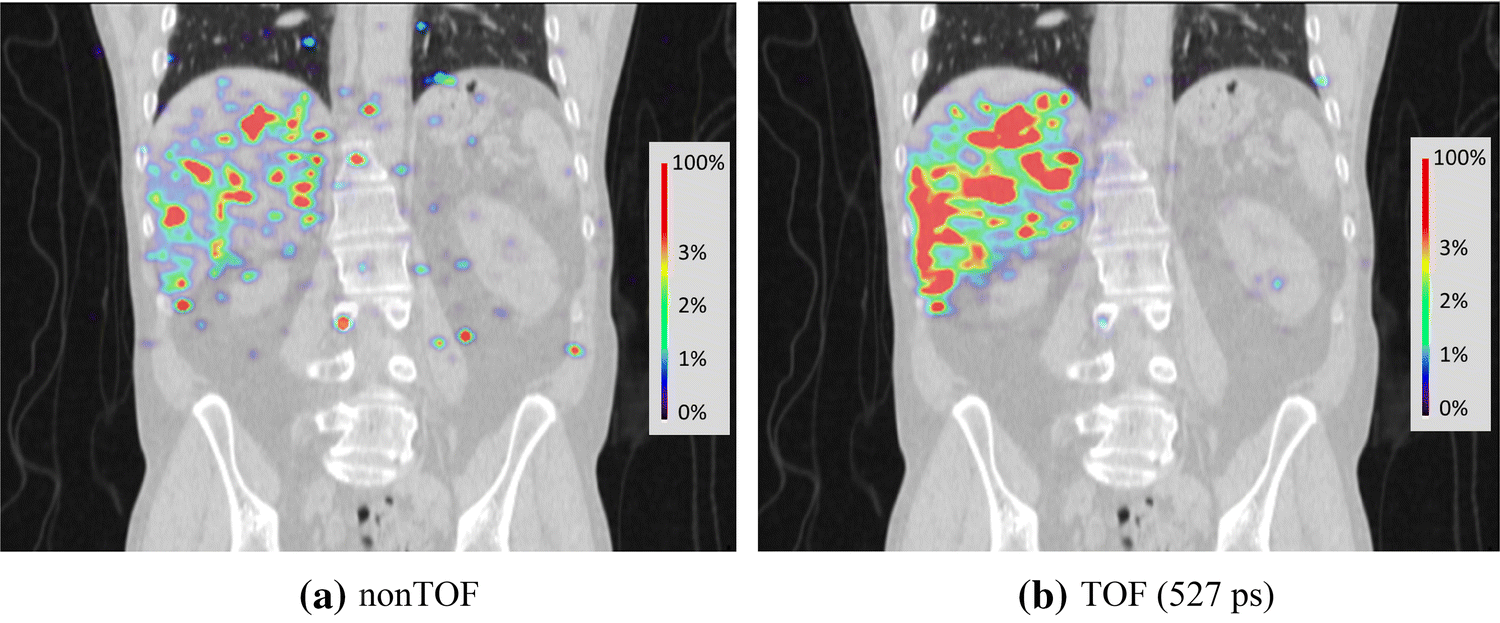 The new opportunities for high time resolution clinical TOF PET ...