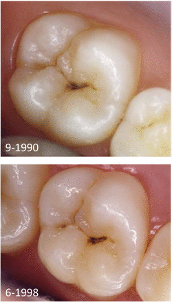 Detection and monitoring of early caries lesions: a review | SpringerLink