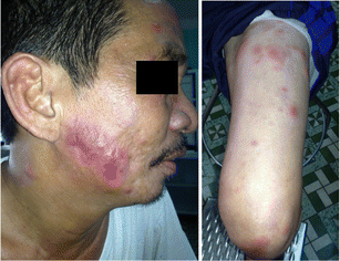 Clinical Characteristics and Treatment of Leprosy | SpringerLink