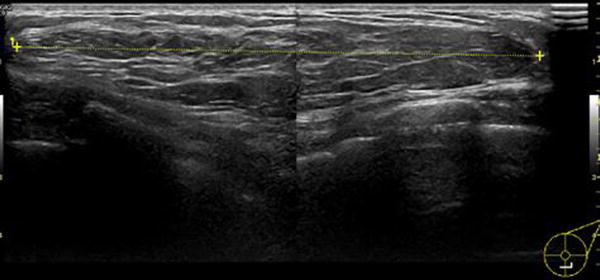 Breast hamartoma: ultrasound, elastosonographic, and mammographic ...