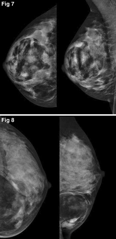 Breast hamartoma: ultrasound, elastosonographic, and mammographic ...