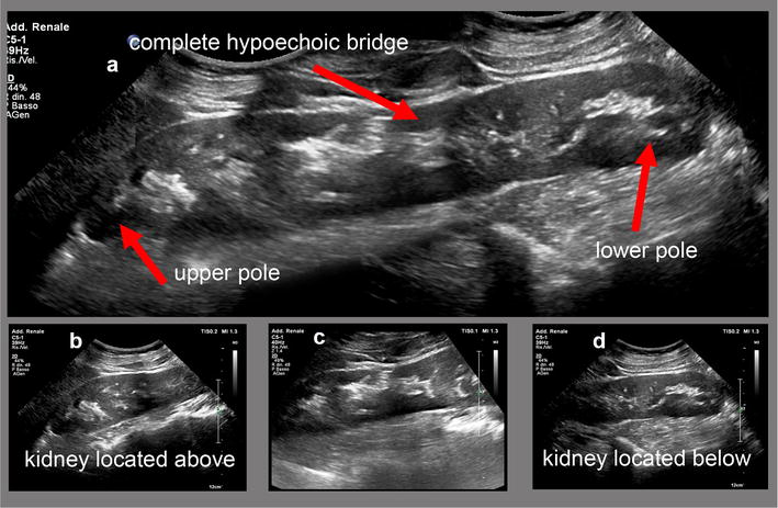 Crossed fused renal ectopia: case report and review of the literature ...