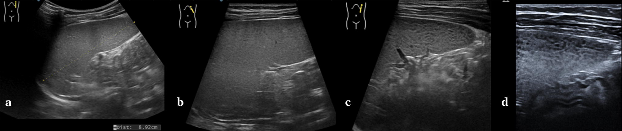 Ultrasonography of the pediatric spleen: a pictorial essay | SpringerLink